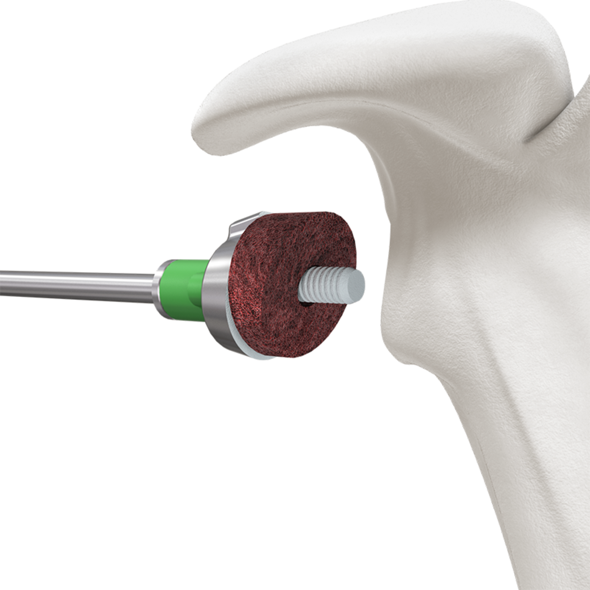 Schulterimplantate | Mathys